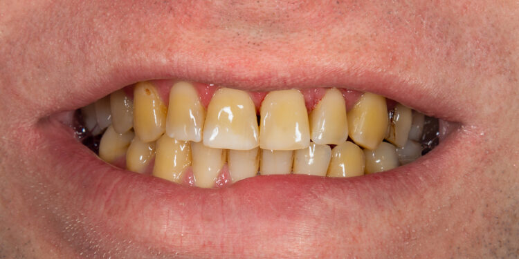 What Does Cocaine Do to Your Teeth? How It Impacts Your Teeth And Gums ...