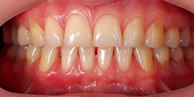 Why Are My Gums Covering My Teeth? Understand Different Causes ...