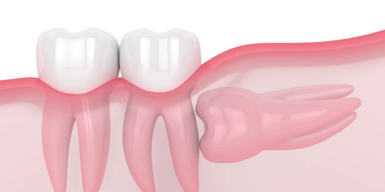 Can Wisdom Teeth Fall Out? Is It A Natural Process Or Not? - Brussels ...