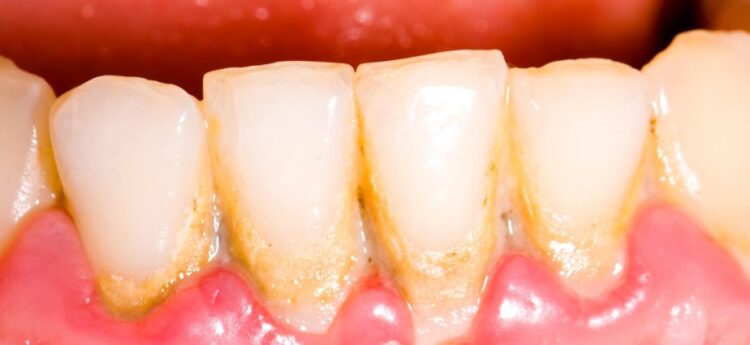 How To See Plaque On Teeth? The Home Dental Plaque Identification Test ...