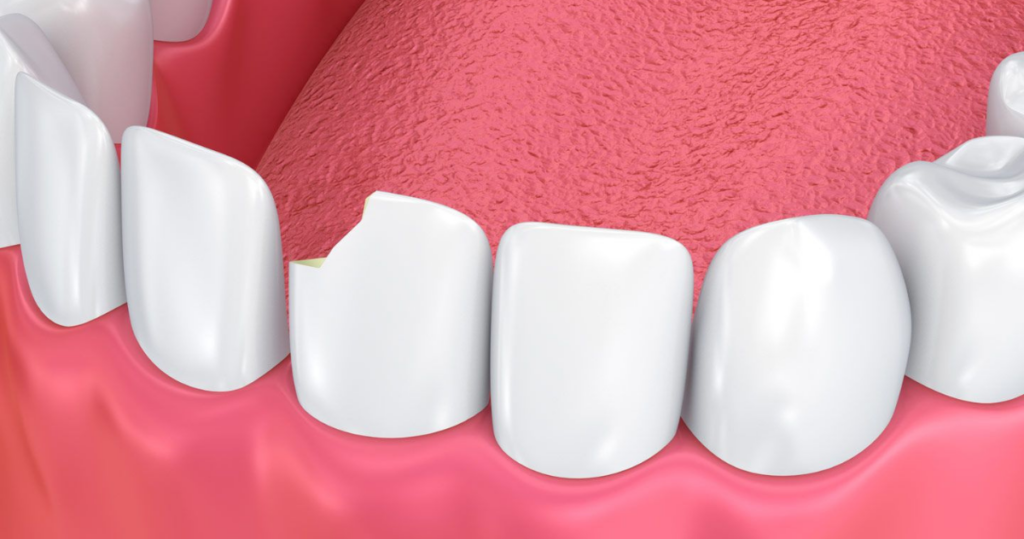 Why Do My Teeth Chip Easily? Exploring The Causes - Brussels Morning ...