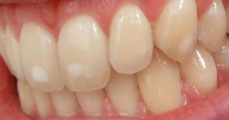 How To Remove Calcium Deposits On Teeth? Exploring The Different Ways ...
